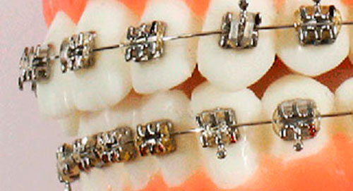 Ortodoncia - Servicios, planes y tarifas de ortodoncia - Precios ...